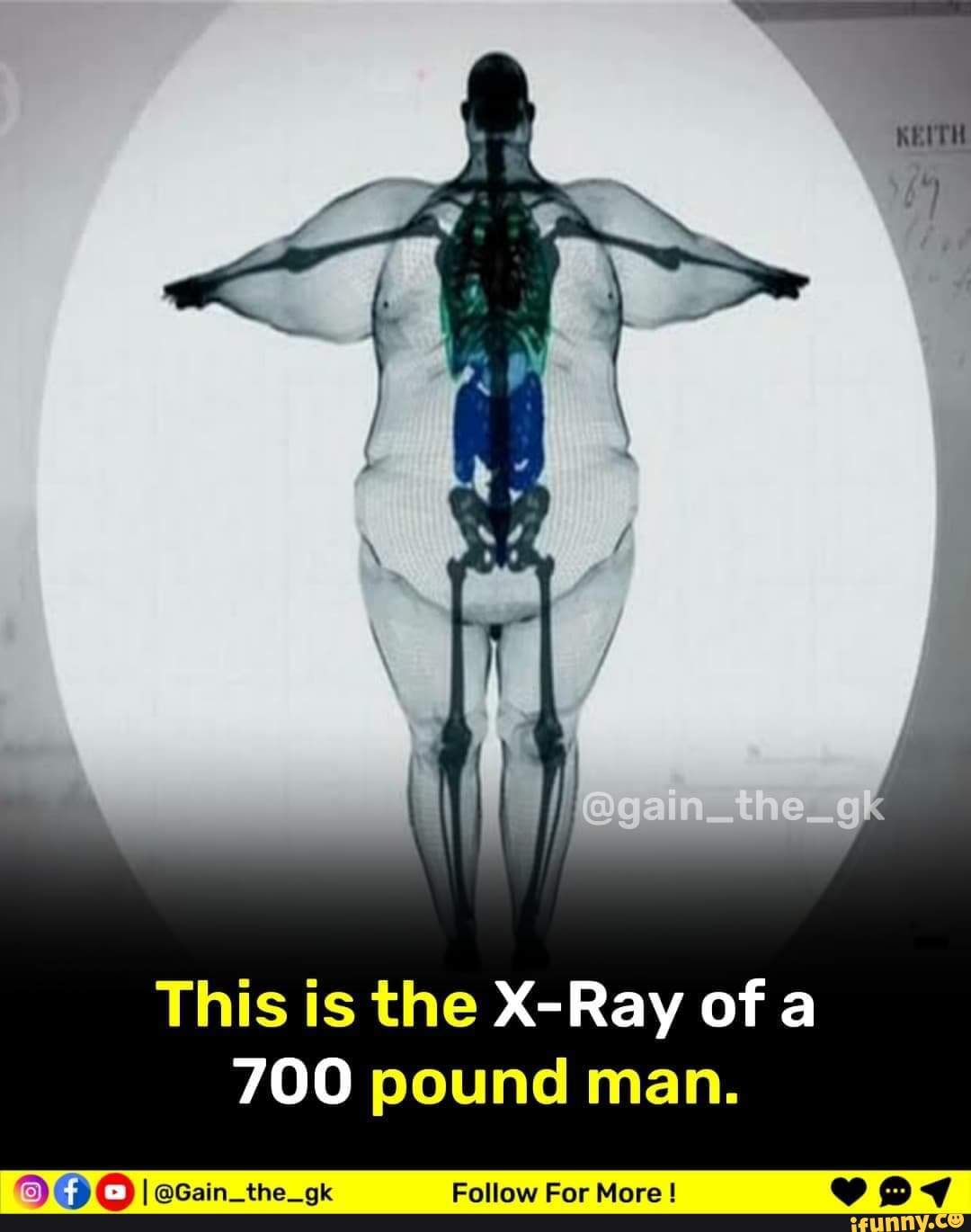 This is the X-Ray of a 700 pound man. Ca PAI mein the Calinus Car Maro ...