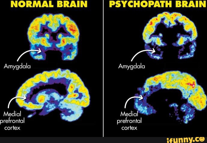 Amygdala memes. Best Collection of funny Amygdala pictures on iFunny