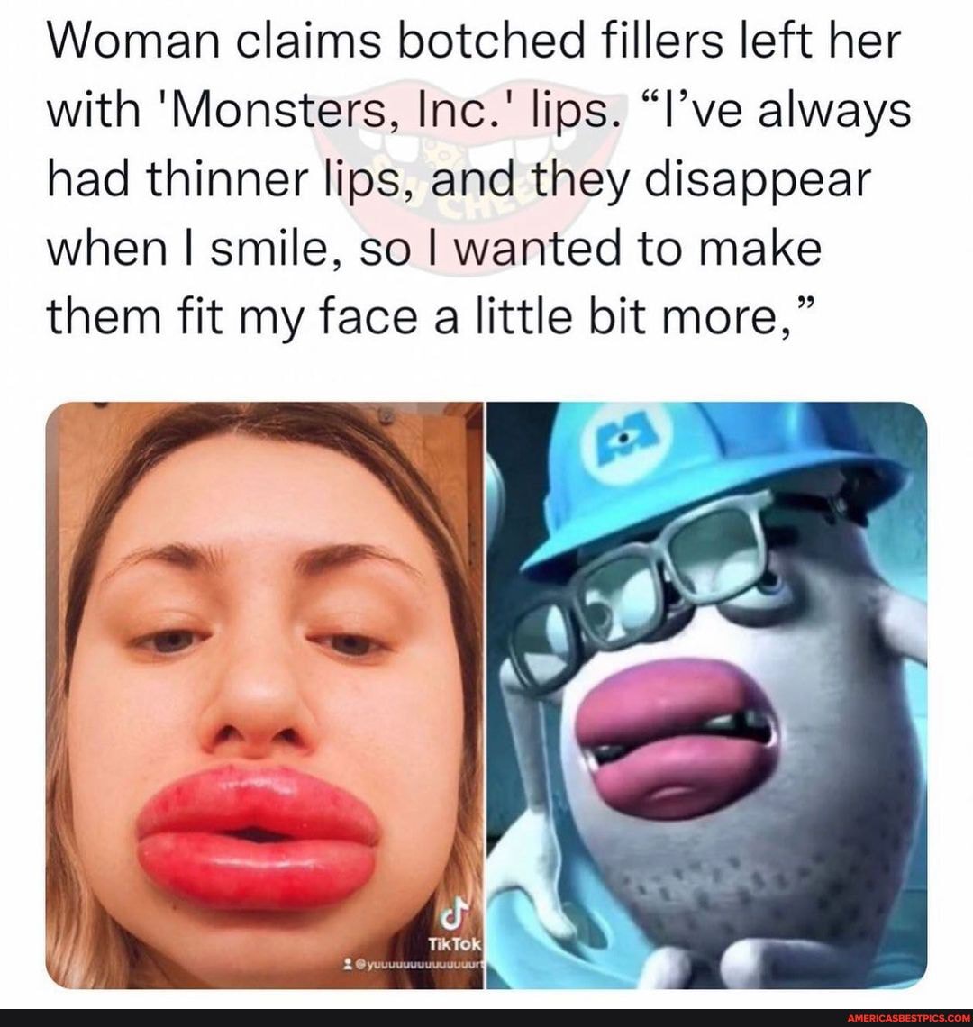 Woman claims botched fillers left her with 'Monsters, Inc.' lips. "I've ...