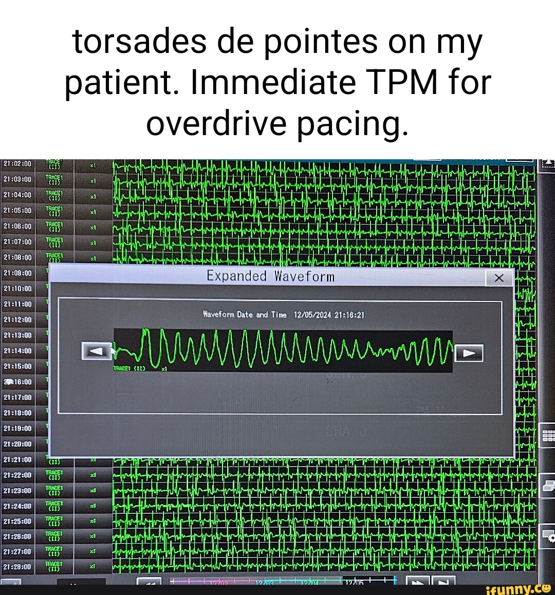Torsades de pointes on my patient. Immediate TPM for overdrive pacing ...