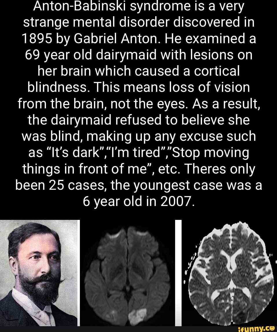 Anton-Babinski syndrome is a very strange mental disorder discovered in ...