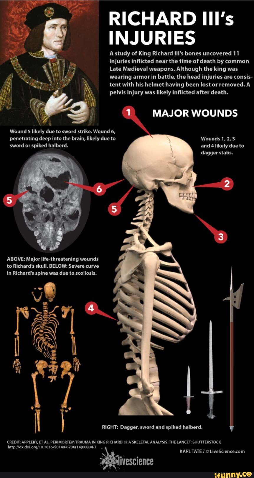 RICHARD III's INJURIES A study of King Richard Ill's bones uncovered 11 ...