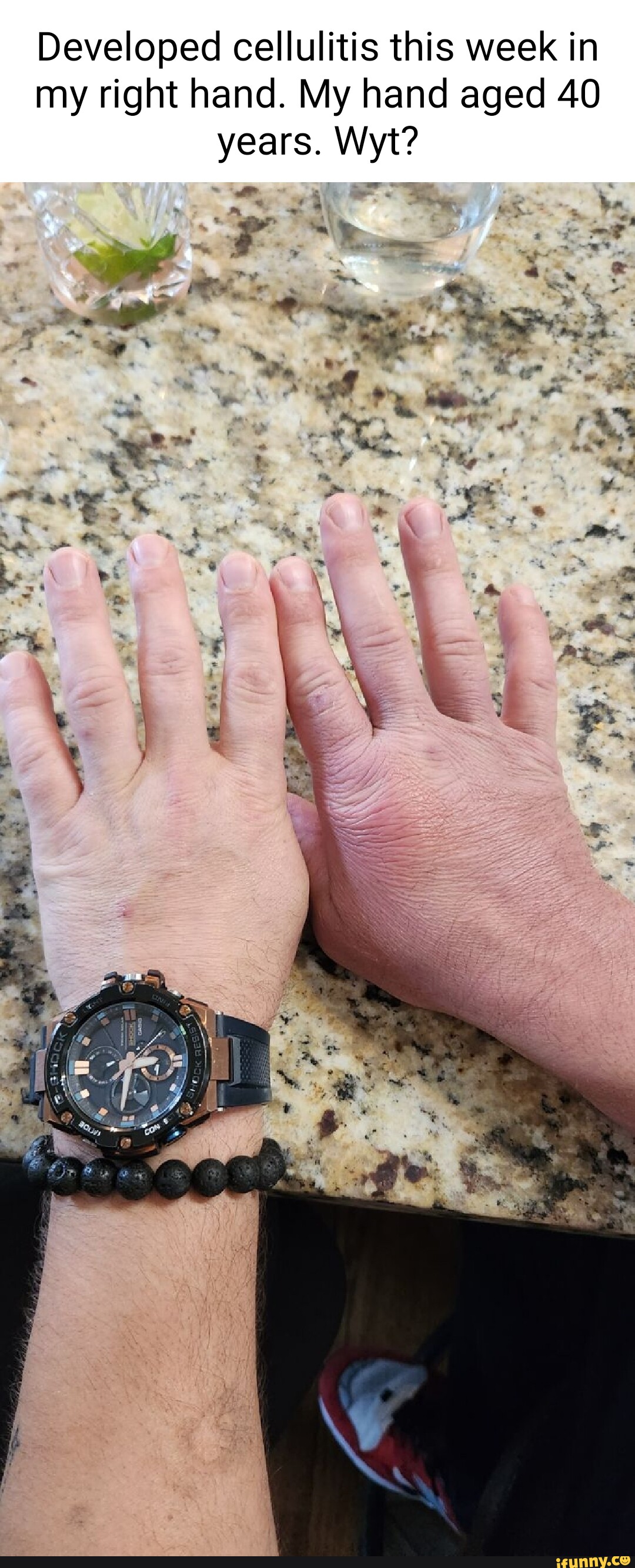 Developed cellulitis this week in my right hand. My hand aged 40 years ...