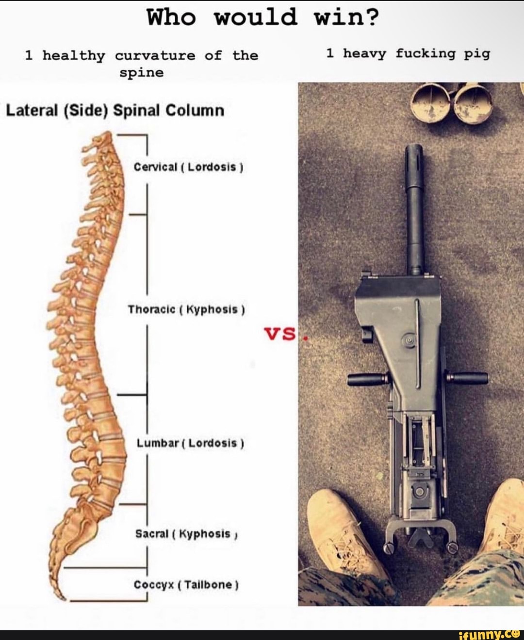 Kyphosis memes. Best Collection of funny Kyphosis pictures on iFunny