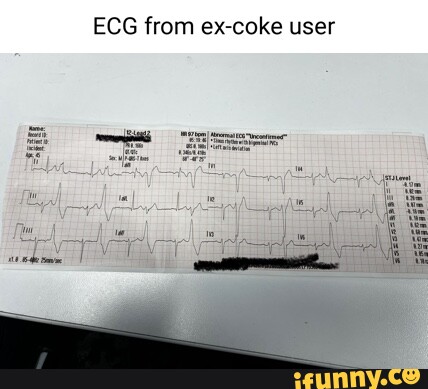 Ekg memes. Best Collection of funny Ekg pictures on iFunny